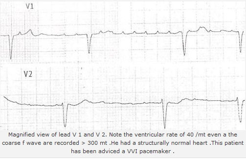 Atrial Fibrillation With Slow Ventricular Response 네이버 블로그
