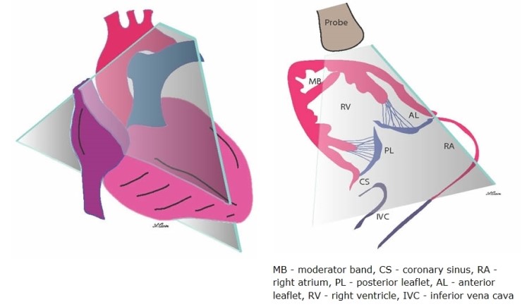 RV (1) : Long axis view of right ventricular inflow (⁠RV inflow view ...