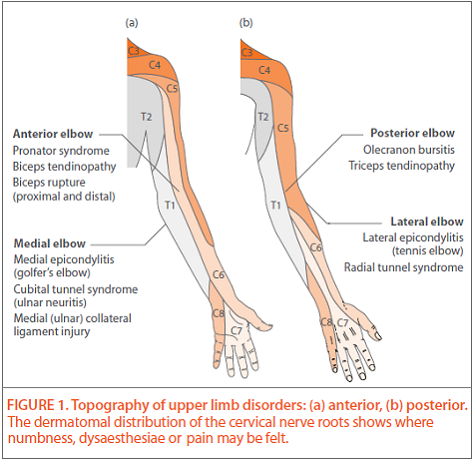 손저림 팔저림의 원인 1: 상지 신경포착 upper extremity nerve entrapment : 네이버 블로그