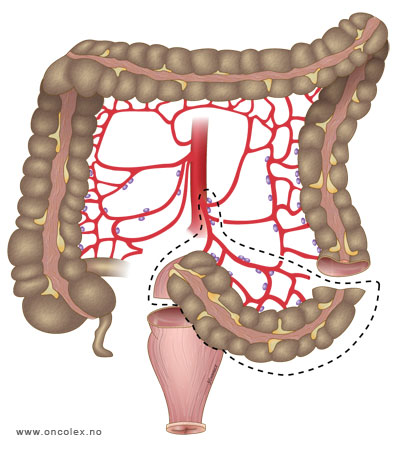 explo lapa + hartmann op : 네이버 블로그