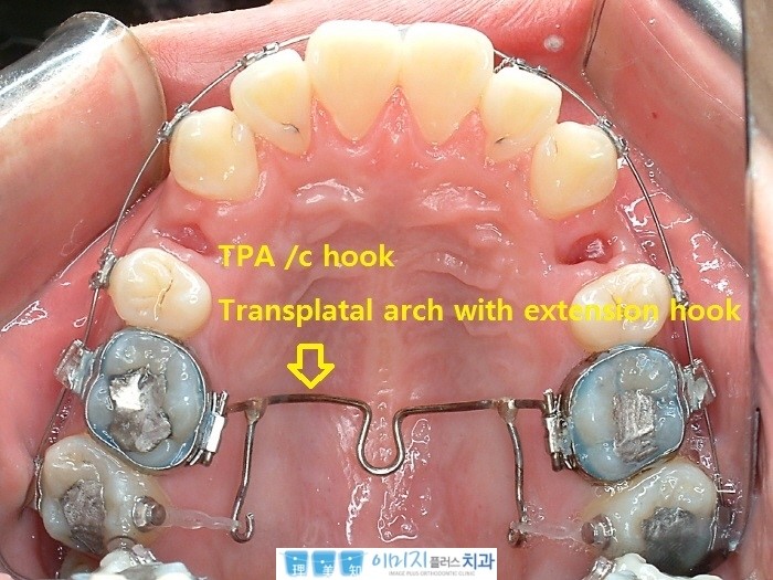 Removale TPA with extension hook [이미지플러스 교정치과] : 네이버 블로그