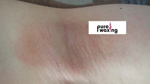 신도림퓨어왁싱여자 겨드랑이 왁싱시술사진다리 인그로운헤어신도림왁싱 잘하는곳신도림 브라질리언 왁싱샵비키니왁싱 전문구로왁싱