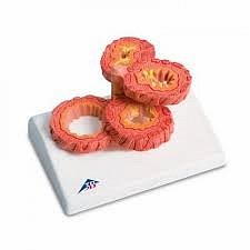 만성폐질환모형,COPD Model : 네이버 블로그