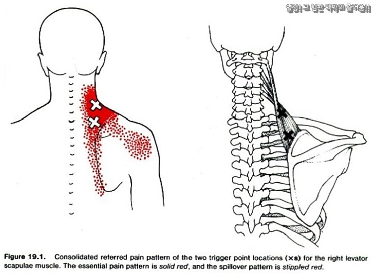 트리거포인트(Trigger Point) - 견, 상지 : 네이버 블로그
