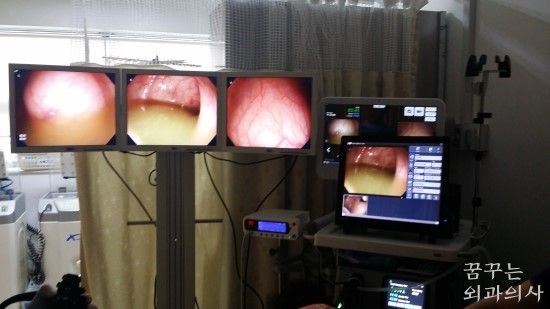 Endochoice사의 광시야각내시경(Full Spectrum Endoscopy: FUSE) 사용기-안산 한사랑병원 : 네이버 블로그