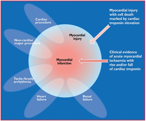 Third Universal Definition of Myocardial Infarction : 네이버 블로그