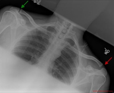 AC-CC Joint repair : 네이버 블로그