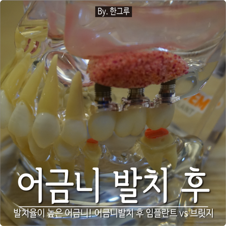 어금니 발치 후 임플란트와 브릿지 비교 네이버 블로그