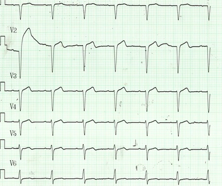 Poor R Wave Progression (PRWP) ECG : 네이버 블로그