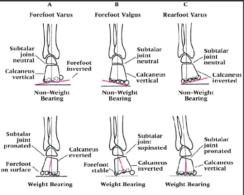 기초 트레이닝의 원리[foot structural deformity(발의 구조적 변형)] : 네이버 블로그
