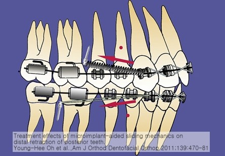 total arch distalization : 네이버 블로그