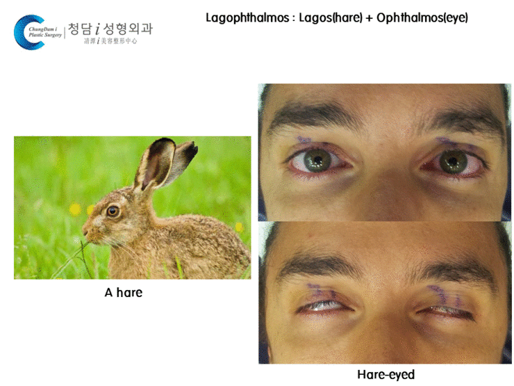 토안증(토끼눈증,lagophthalmos)의 진단과 치료 : 네이버 블로그