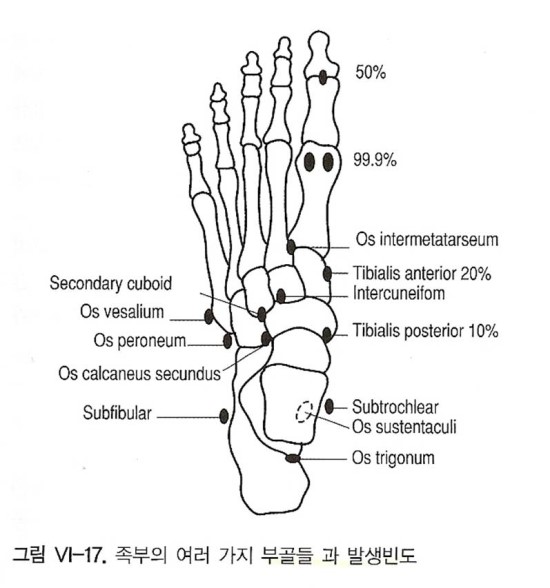accessory bones of foot (족부의 부골) - accessory navicular (부주상골) 외 : 네이버 블로그