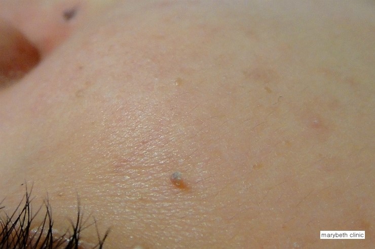 실모양사마귀(사상사마귀, Filiform wart) 또는 손가락모양사마귀(Digitate wart) : 네이버 블로그