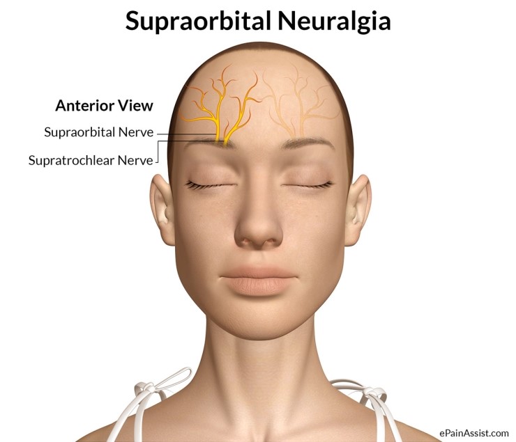안와상 신경통 - Supraorbital Neuralgia : 네이버 블로그