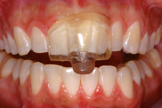NTI splint? 이갈이 스플린트 : 네이버 블로그
