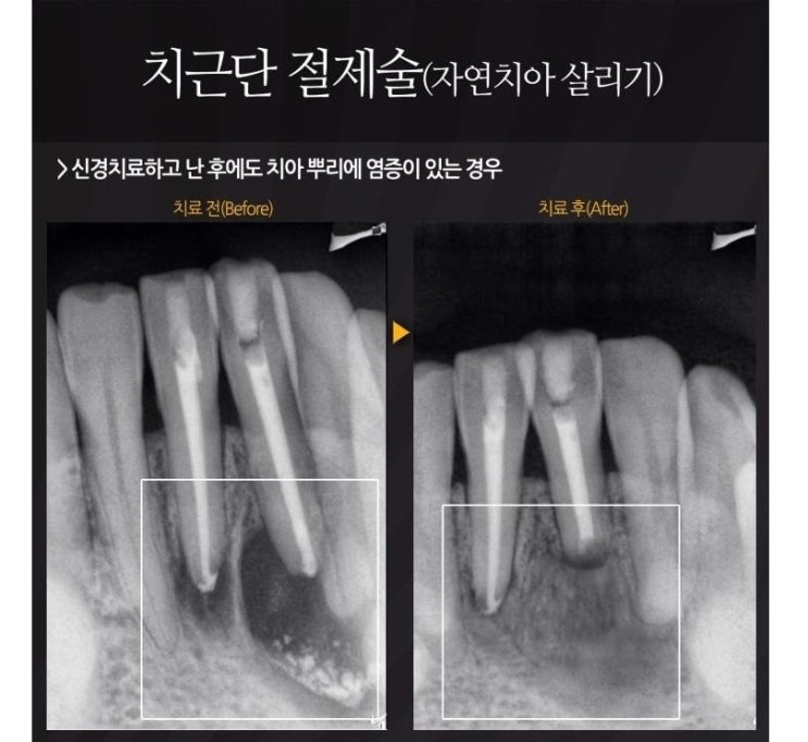 치근단절제술 로 자연치아 살리기 치아뿌리염증수술 잇몸염증치료 강남 사람사랑에서 직접한 치과수술 네이버 블로그