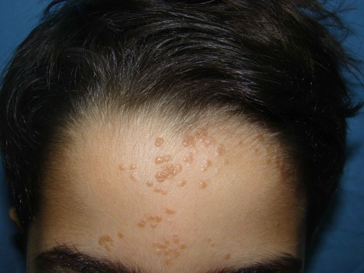 사마귀치료 파헤치기 - 냉동치료,레이저,면역요법 등등 : 네이버 블로그