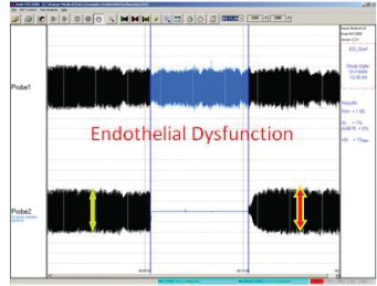 EndoPAT을 이용한 내피세포 혈관확장 기능 평가 : 네이버 블로그