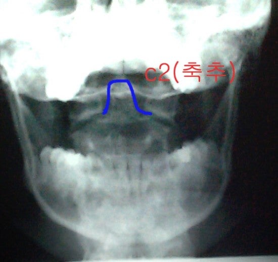 "Open mouth view" : 네이버 블로그