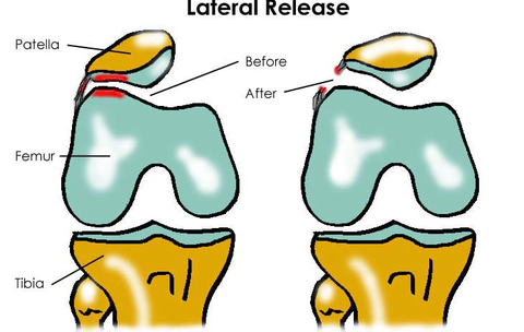 Synovectomy of septic knee (pf.C) : 네이버 블로그