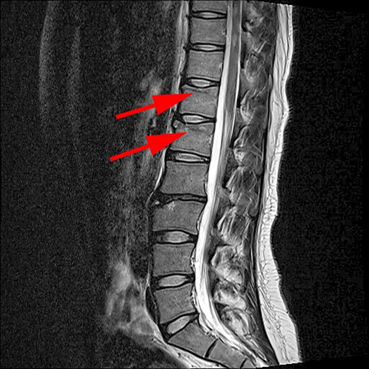 Limbus vertebra vs Fracture : 네이버 블로그