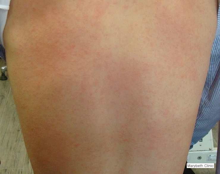 망고피부염 (Mango dermatitis) - 피부질환 아틀라스 : 네이버 블로그