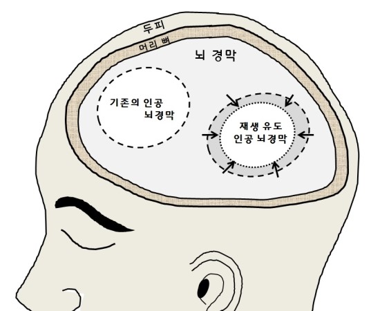 재생의학, 재생경막, 인공경막, dura, dura membrane, redura, 경막성형술, duroplasty : 네이버 블로그