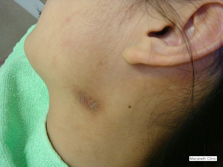 바이올린연주자 목 Fiddler's neck : 네이버 블로그