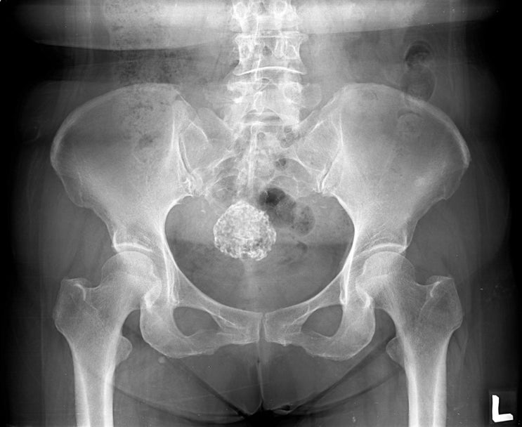 석회화된 자궁근종(Calcified uterine myoma) : 네이버 블로그