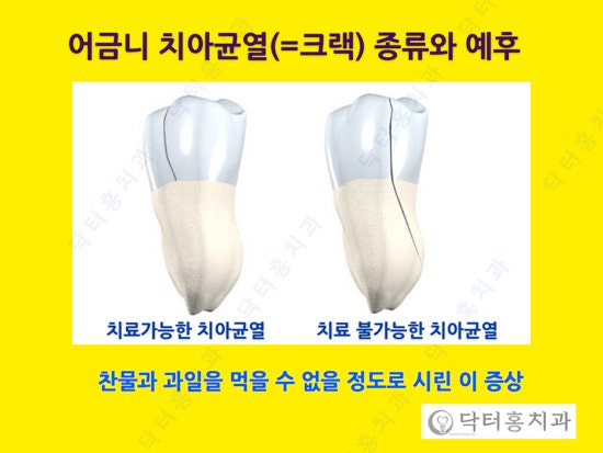 어금니 시린이 증상 씹을 수가 없다 어금니 크랙 치아균열 어금니 살리는 방법 네이버 블로그