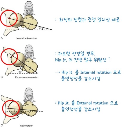 대퇴골의 염전각( Femur torsion angle) 전경/후경(Anteversion/Retroversion) : 네이버 블로그