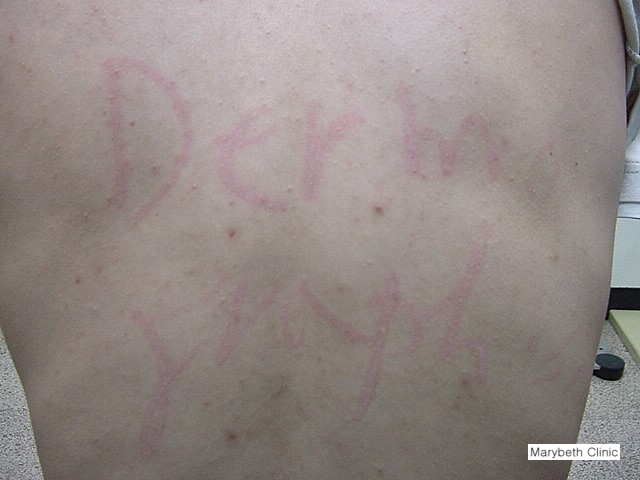 피부그림증 (피부묘기증) Dermographism - 1 : 네이버 블로그