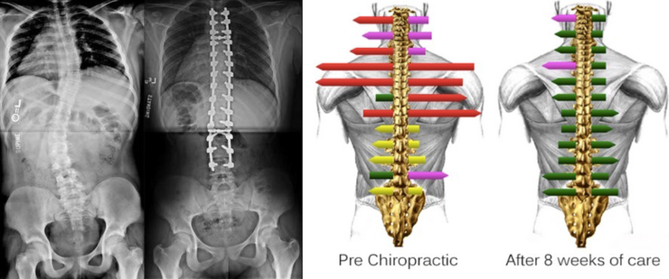 MyoVision sEMG 재활의학과에서의 활용: 정적, 동적, 사지검사 : 네이버 블로그