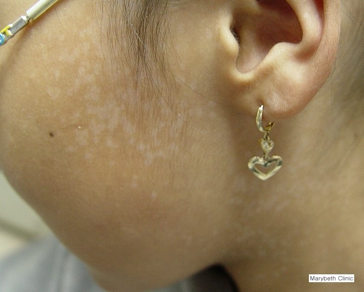 어루러기 Pityriasis versicolor, Tinea versicolor - 얼굴과 목 부위 : 네이버 블로그