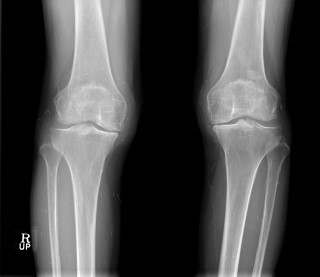 TKRA / valgus knee / femur cutting problem : 네이버 블로그