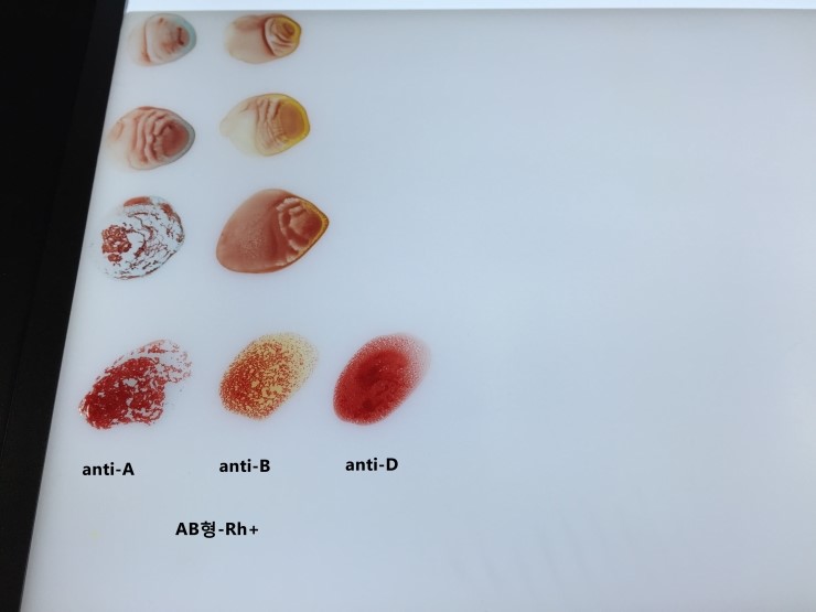 [헬수다] cis-AB형 ABO유전자형검사 / 경찰청사람들 혈액형 때문에 살인사건이 벌어진 희귀혈액형 : 네이버 블로그