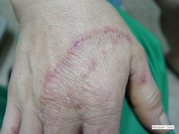 손백선증 (수부백선) Tinea manus - 1 : 네이버 블로그