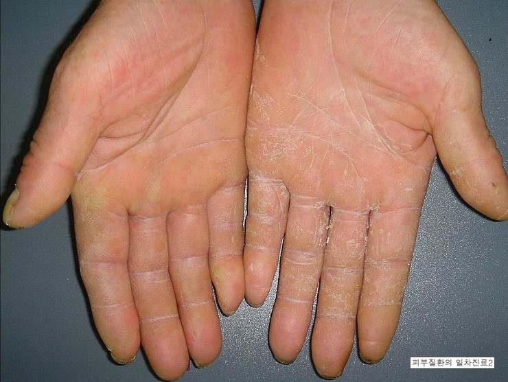 손백선증 (손무좀) Tinea manus - 2 : 네이버 블로그