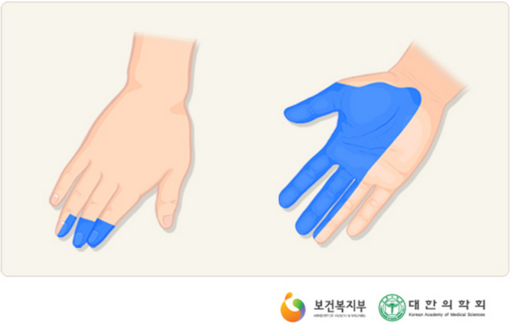 손목터널증후군에 관한 상식 손저림 통증의 흔한 원인 수근관증후군 증상 검사 및 진단과 치료 네이버 블로그