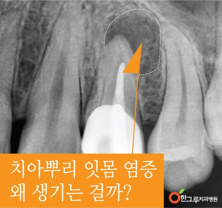치아뿌리염증 왜 생길까 치아뿌리염증 치료법 네이버 블로그