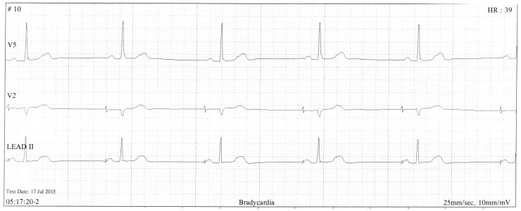 APC bigeminy during AAI pacing : 네이버 블로그