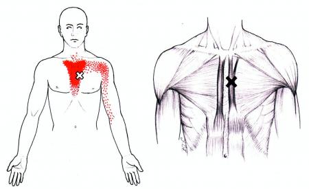 [체간] 3.흉골근 (Sternalis muscle) : 네이버 블로그
