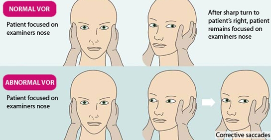 [2부] 어지럼증 환자의 진단적 접근, 두부 충동검사, head impulse test, 현훈환자에서 즉시 뇌촬영을 시행해야 ...