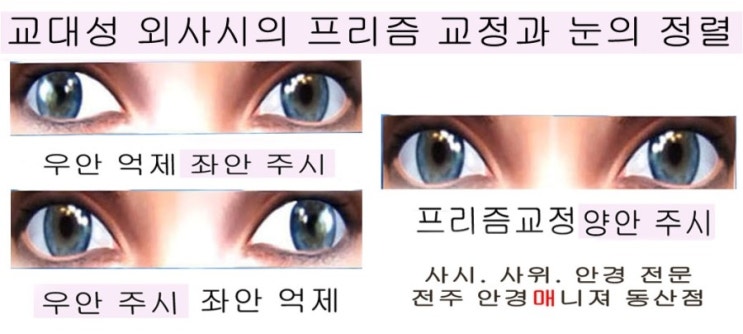 전주 교대성 외사시두 눈을 교대로 주시 프리즘 렌즈 안경 사시검사와 처방이 가능한 양안시 기능 검사 시기능 훈련