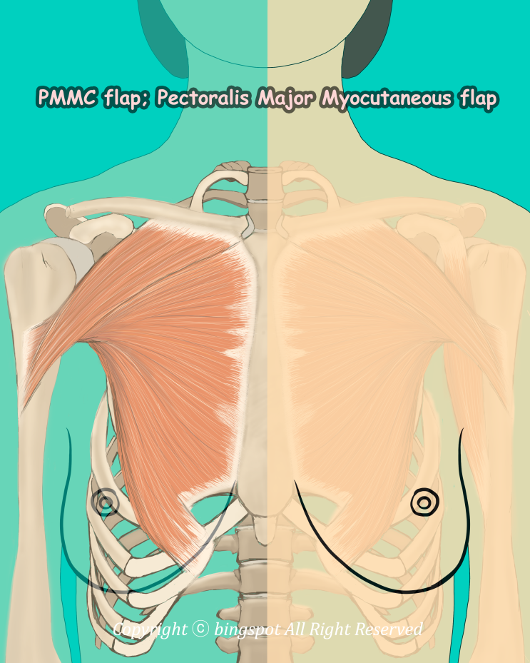 PMMC flap : 네이버 블로그