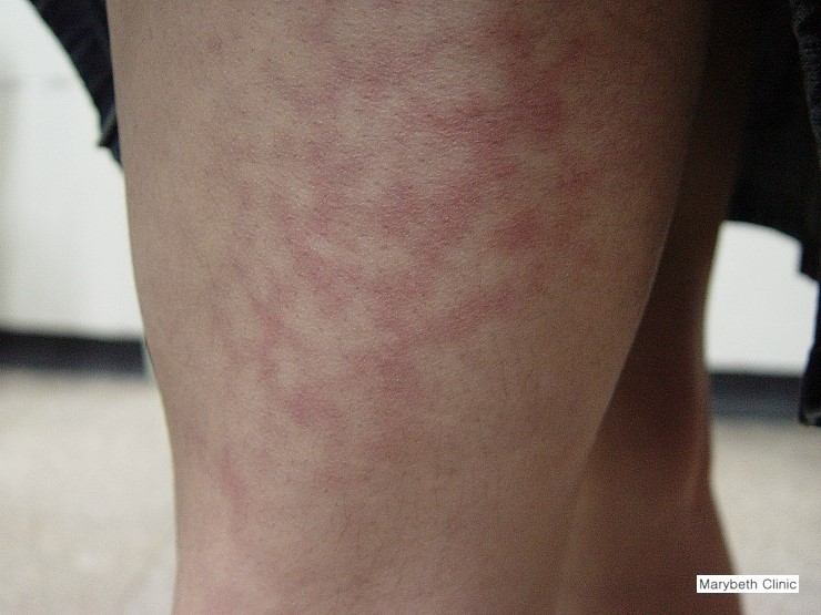 열성홍반 Erythema ab igne - 1 : 네이버 블로그