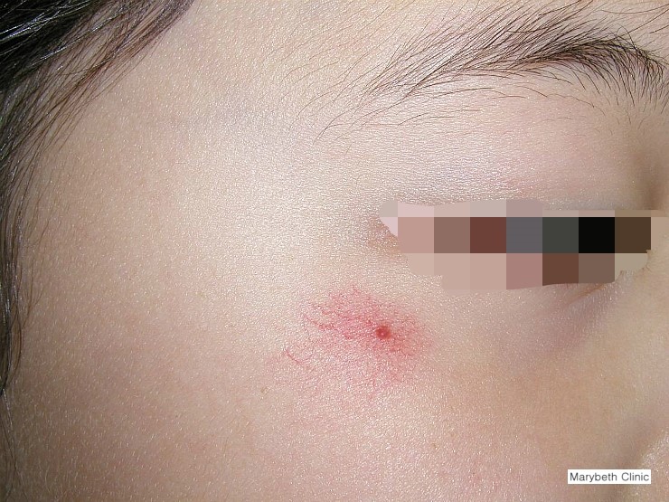 거미모반 (거미혈관종) Spider nevus (Spider angioma) - 1 : 네이버 블로그