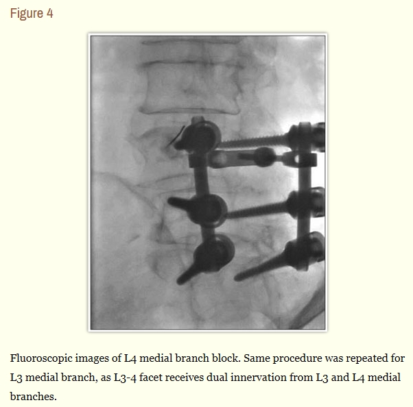 fusion level에 Lumbar MBB : 네이버 블로그