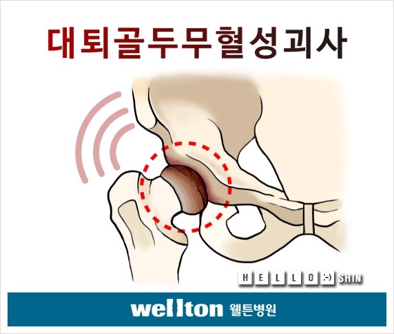 고관절 대표질환 대퇴골두무혈성괴사 증상과 원인 치료까지 네이버 블로그